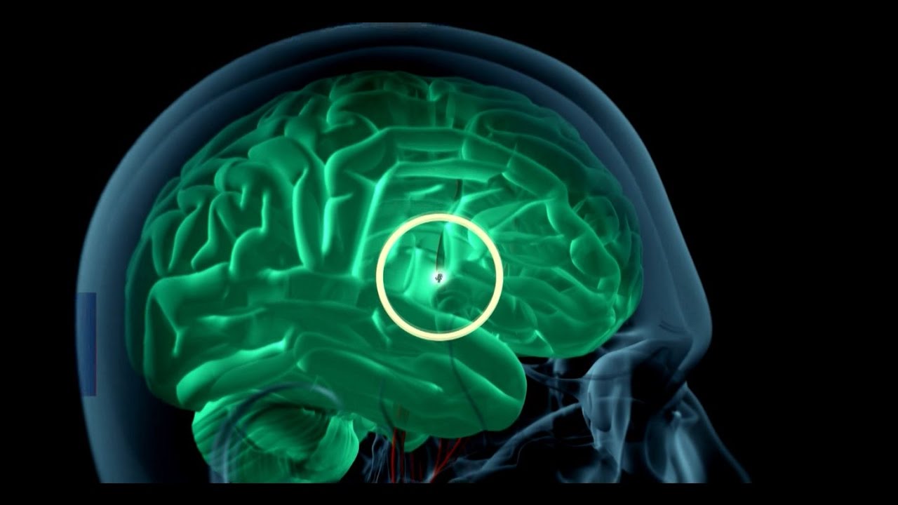 Know Thrombosis: Learn about Stroke Risk with Atrial Fibrillation (AFib ...