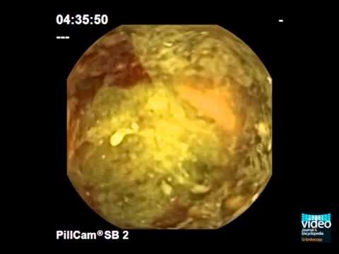 Small Bowel Capsule Endoscopy Visualizing Colonic Adenocarcinoma - YouTube