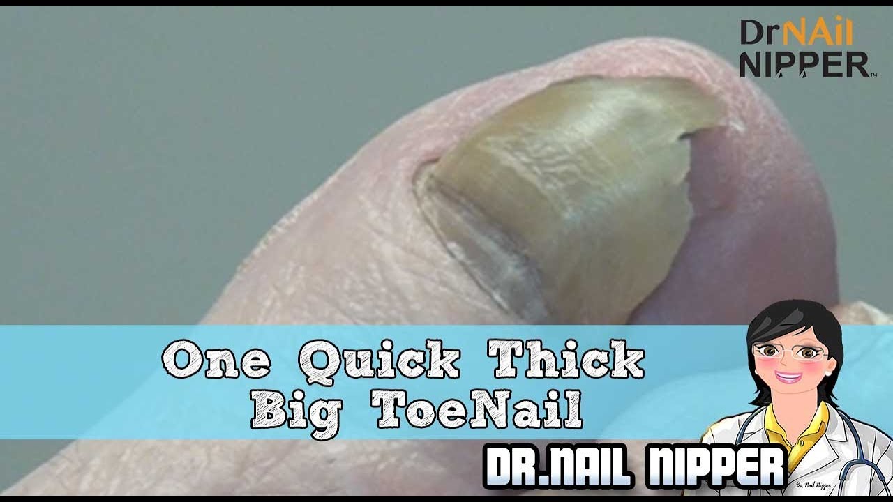 One Quick Thick Big ToeNail - YouTube
