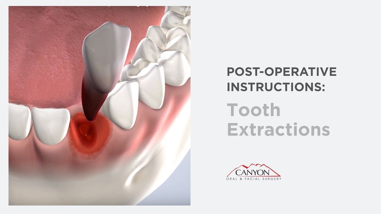 After Extraction Instructions in Las Vegas, NV - YouTube