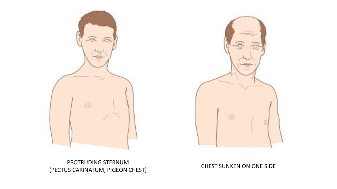 TCM CAUSES OF PROTRUDING STERNUM (PECTUS CARINATUM, PIGEON CHEST ...