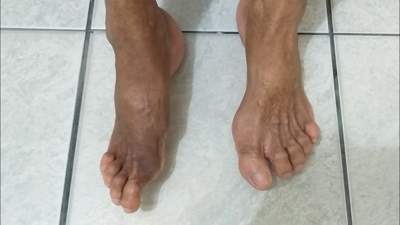 Apareceu uma coisa preta no dedo do pé e teve que amputar #diabetes # ...