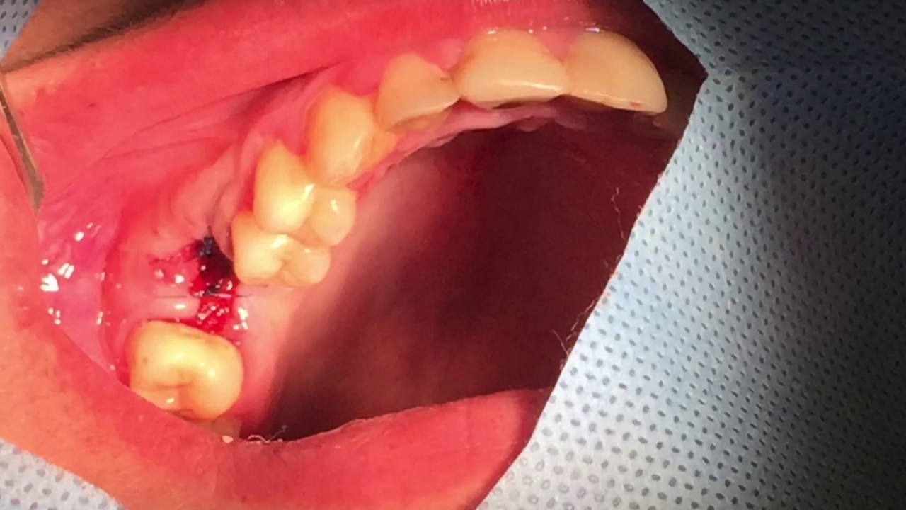 Cicatrización tejidos Cirugia Bucal oral. 2/3 Reparación Alveolo - YouTube