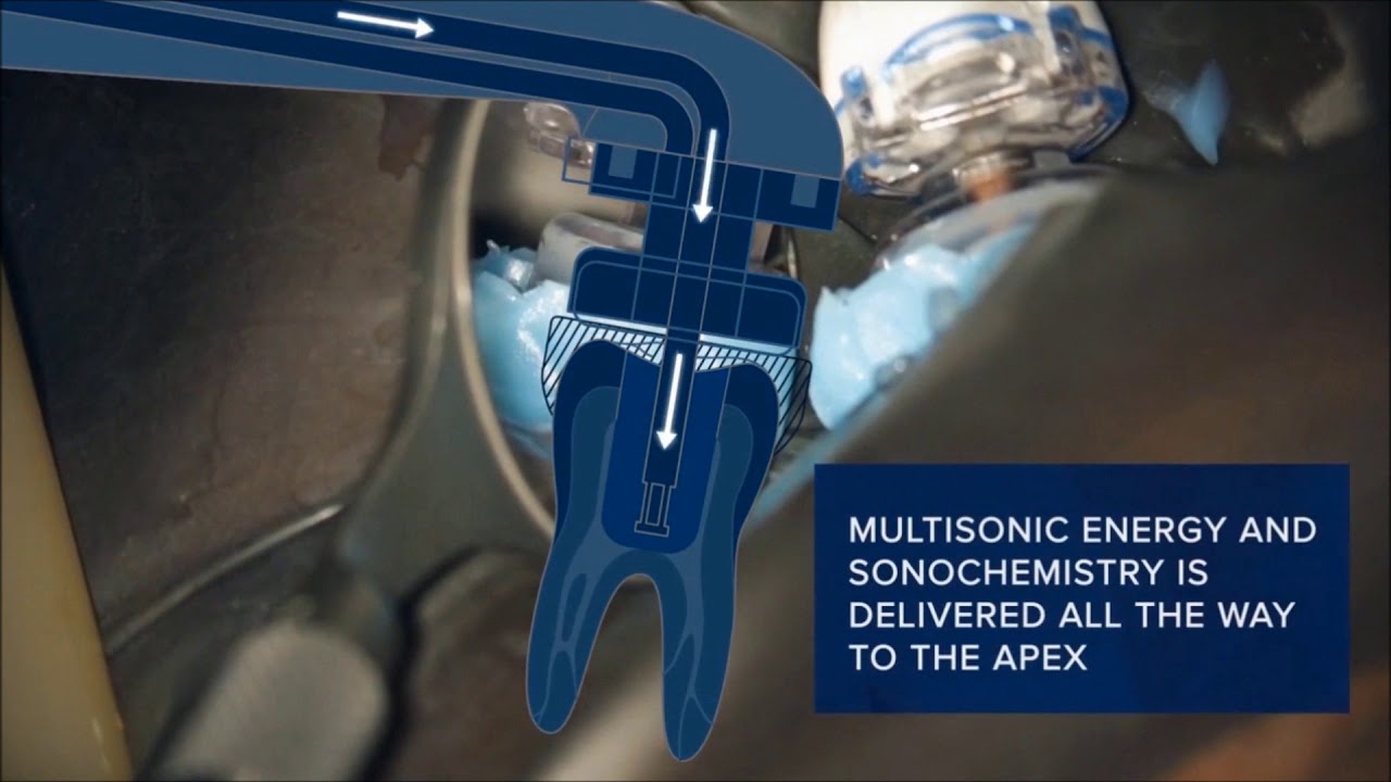 Forbes Endodontics GentleWave - YouTube