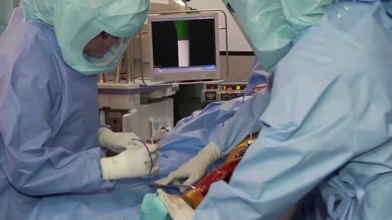 Accuracy of 3D Planning and Navigation in Bone Tumor Resection by Lucas ...