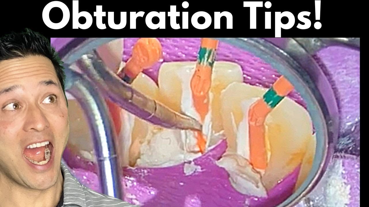 Root Canal Obturation Simplified - Tips to Save You Time! - YouTube