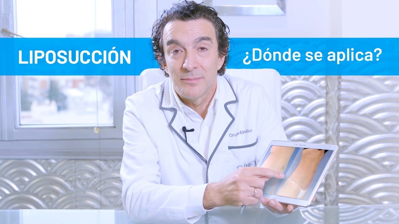 Qué es la Liposucción y Cómo se Aplica - YouTube
