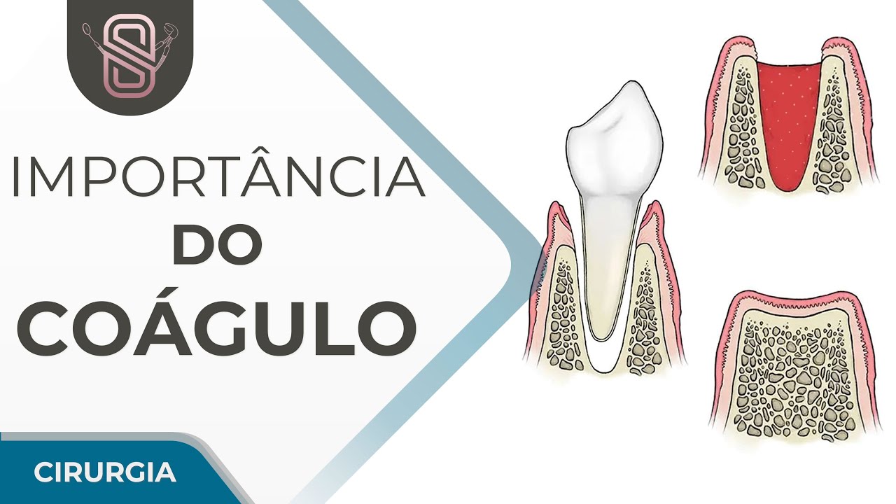 Cavidade Seca Vs Coagulo Sanguineo Importância Da Rede De Fibrina Na
