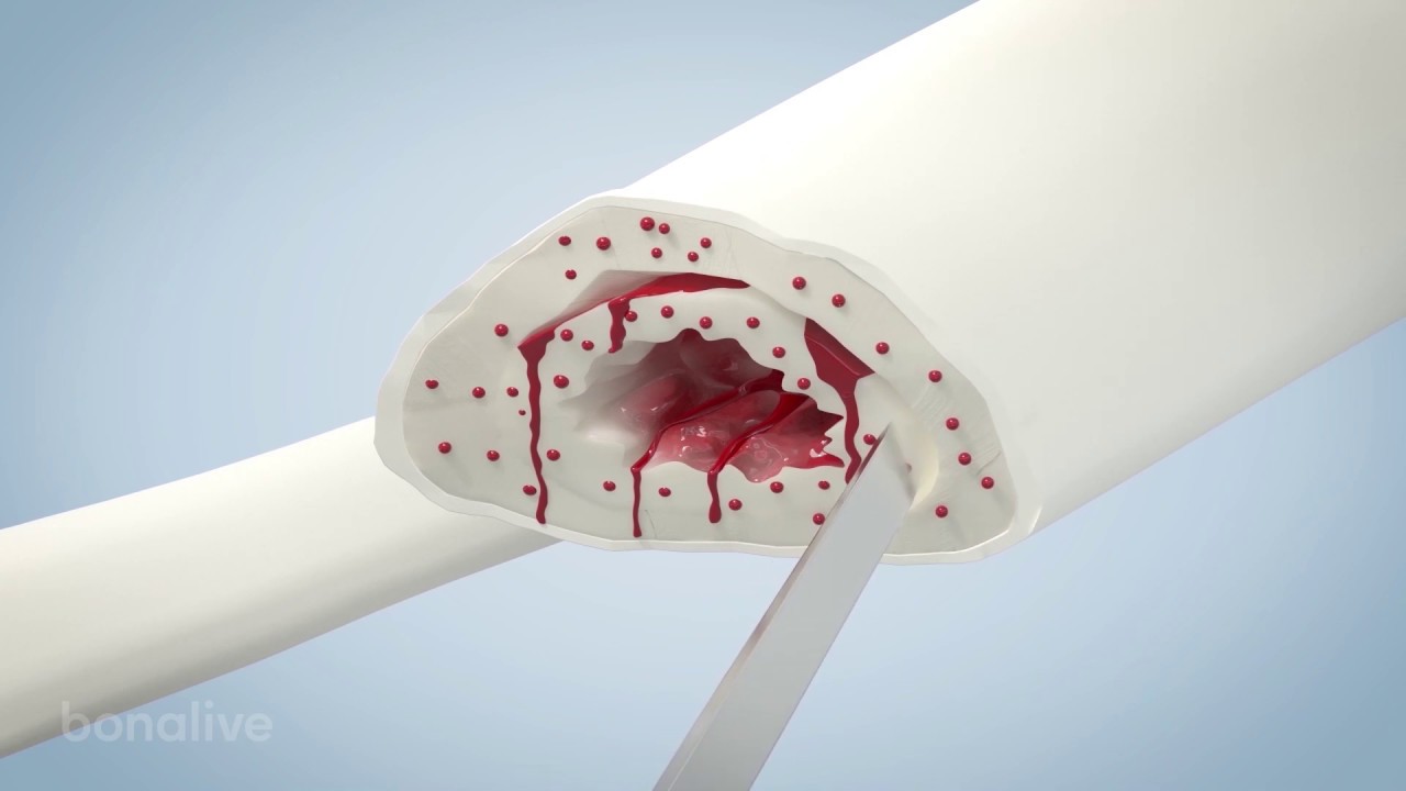 Bonalive granules in septic non-union treatment - YouTube