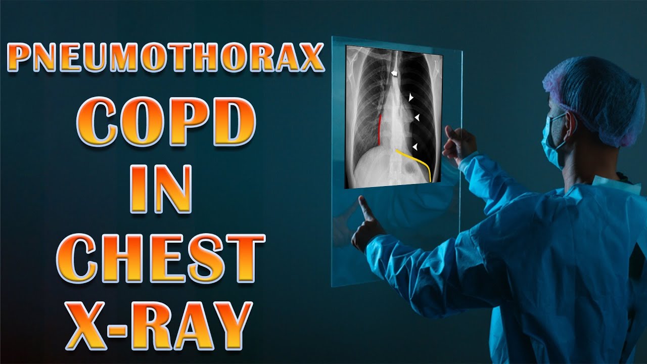 Chest X-Ray - 04 - ll Hyperlucent Lesions ll ( Pneumothorax & COPD ...