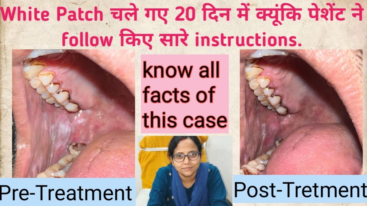 White Patch Inside Cheek White Patch 20 white-patch-inside-cheek-white-patch-20