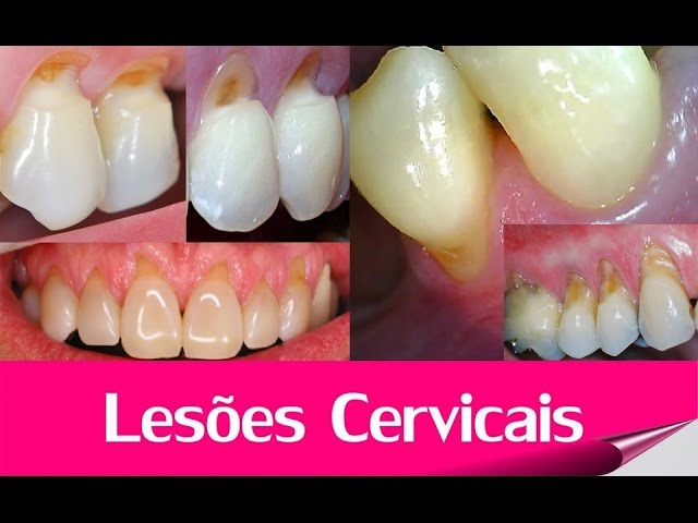 Abrasao Dentaria Pasta Para Micro Abrasão Opalustre Ultradent