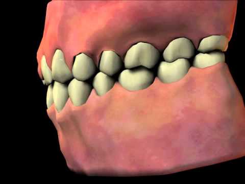 Gingival Hyperplasia - YouTube