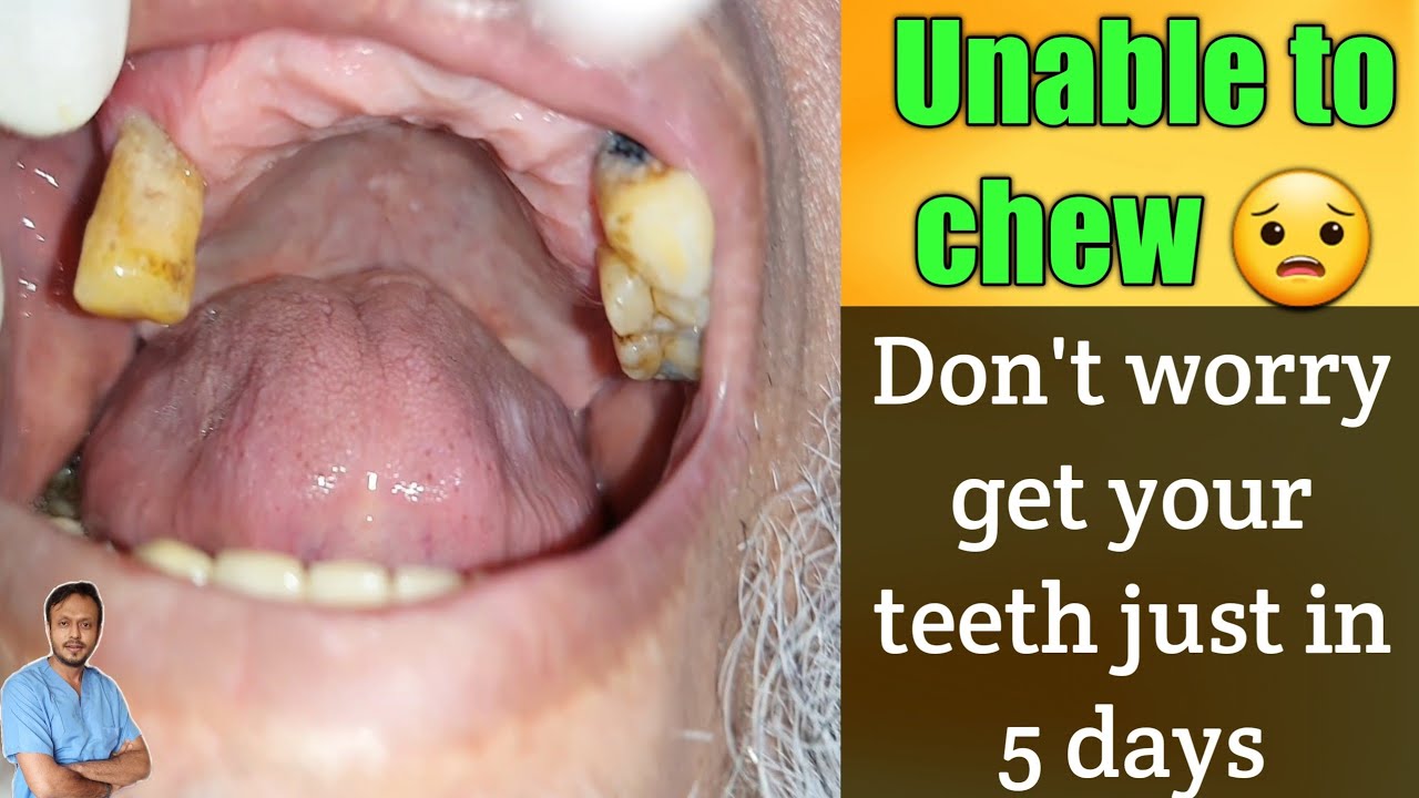 Patient age 73, Not able to chew and smile since many years - YouTube
