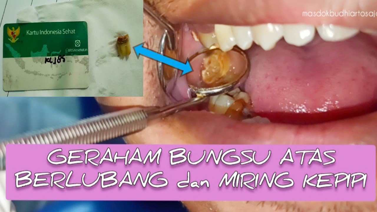Pencabutan Geraham Bungsu Atas Miring Kepipi di Puskesmas Dengan ...