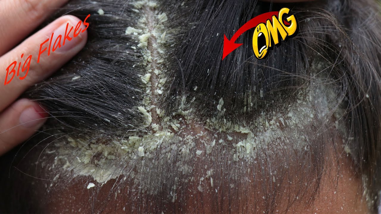 Very Satisfying Huge Dandruff Flakes Founding Hundred Worms Living ...