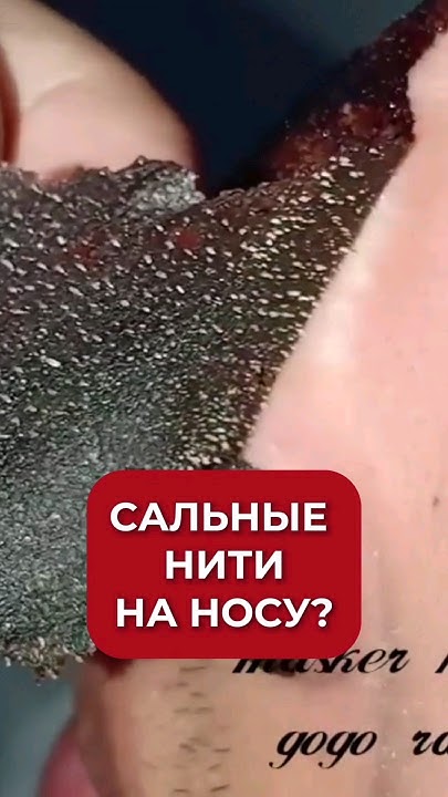 Как избавиться от черных точек и сальных нитей #черныеточки #прыщи # ...