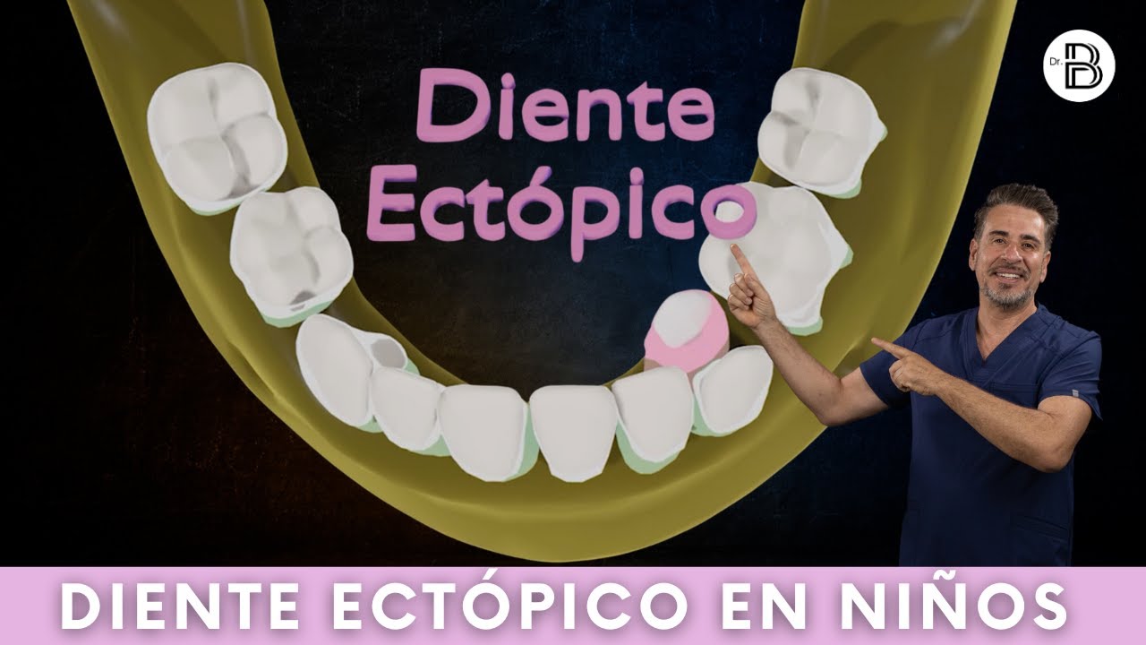 ¿Tienes un DIENTE ECTÓPICO? 🦷 - YouTube