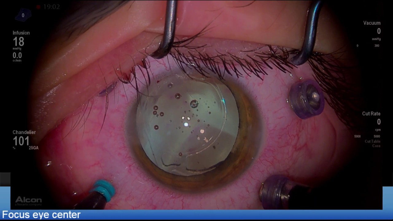 Funnel retinal detachment in 15 yr old boy Lukan Mishev Live Stream ...