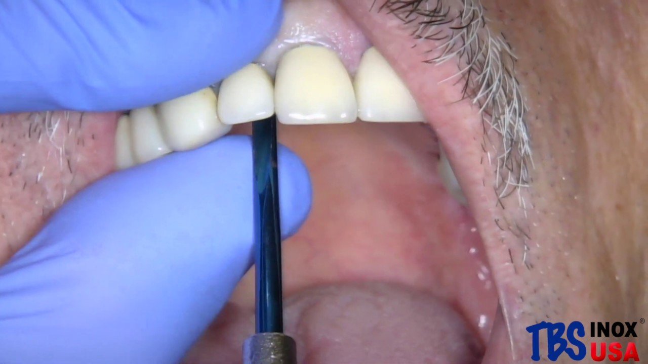 Atraumatic Extraction using TBS instrumentation - YouTube