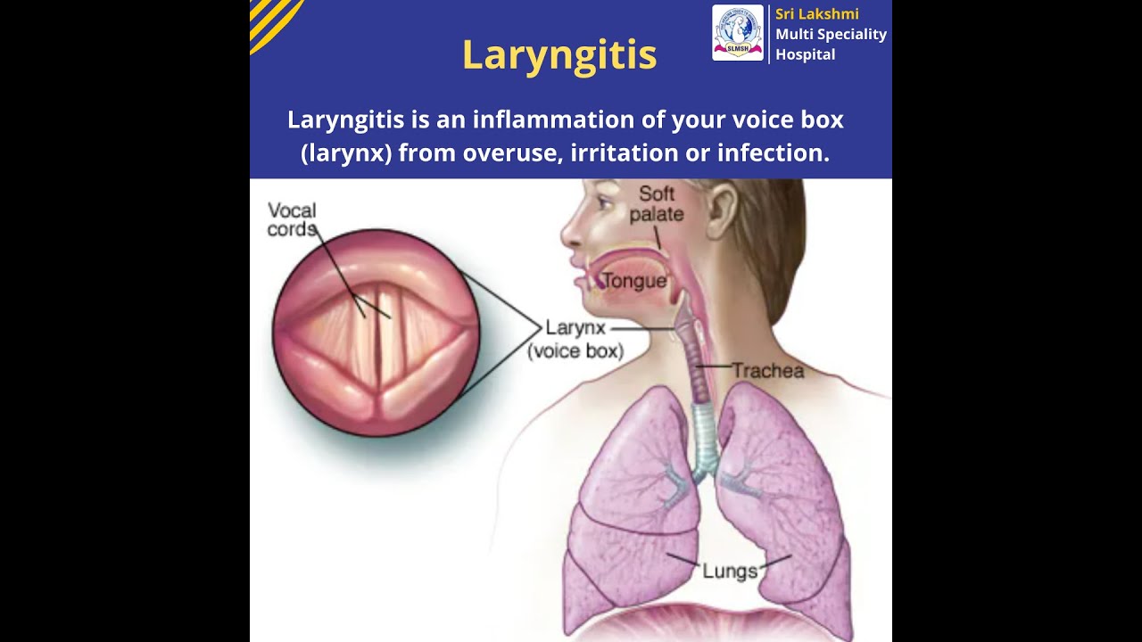 Laryngitis Diagram