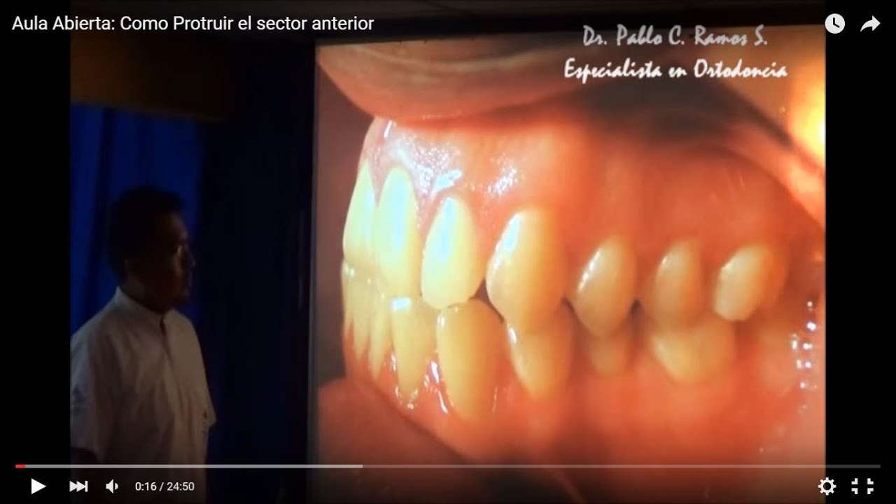 Aula Abierta: Como Protruir el sector anterior - YouTube