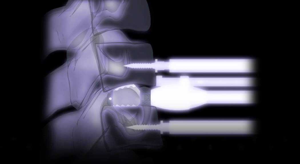 ROI-C Technique Animation - YouTube