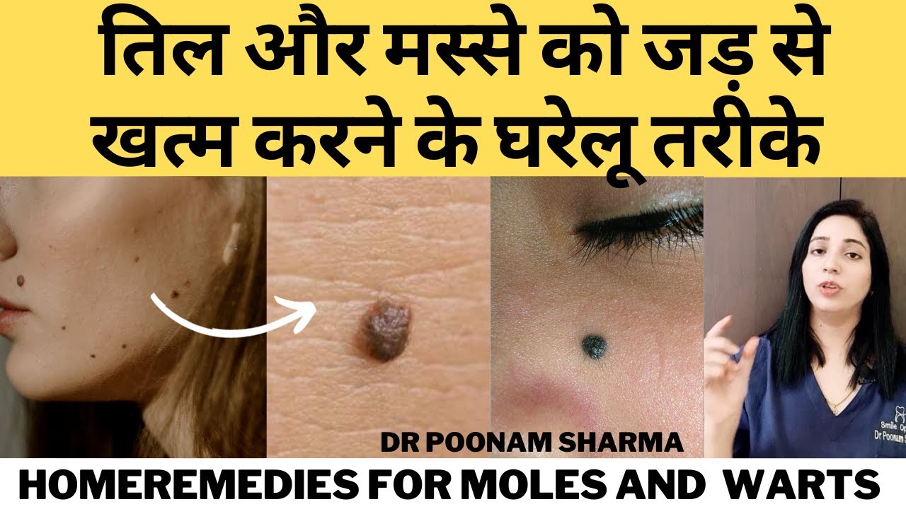 मस्से और तिल जड़ से ख़त्म करने का घरेलु इलाज। Home Remedies For Warts ...