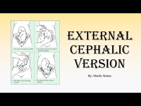 [O&G] External cephalic version, turning a breech baby into cephalic ...