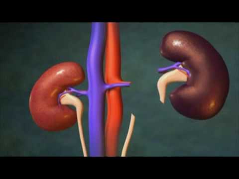 TRANSPLANTATION RÉNALE GREFFE DU REIN - YouTube