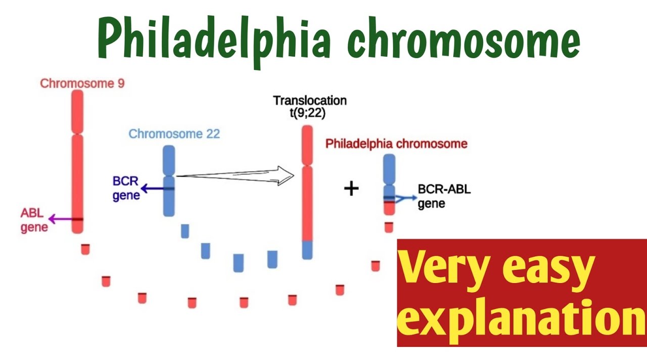 Philadelphia chromosome | BCR-ABL translocation | Tyrosine kinase ...