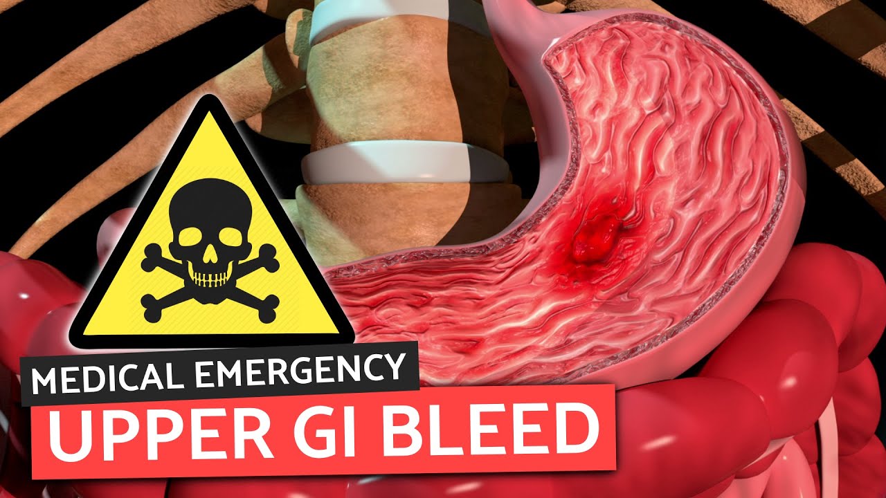Upper GI Bleeds for Medical/PA Finals | Medical Emergencies Made Easy ...