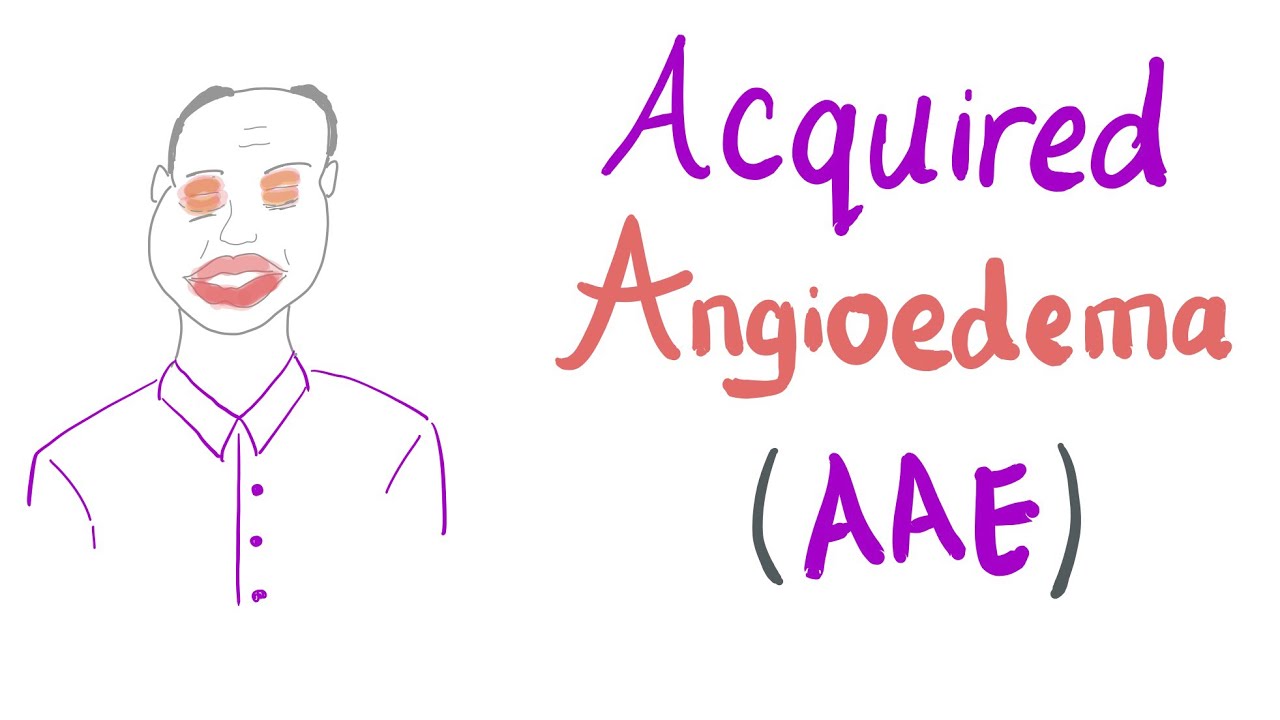 Acquired Angioedema (AAE) - YouTube