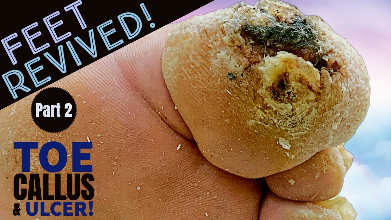Feet Revived, Part 2: Trimming of the Thick Big Toe Callus and Wound ...