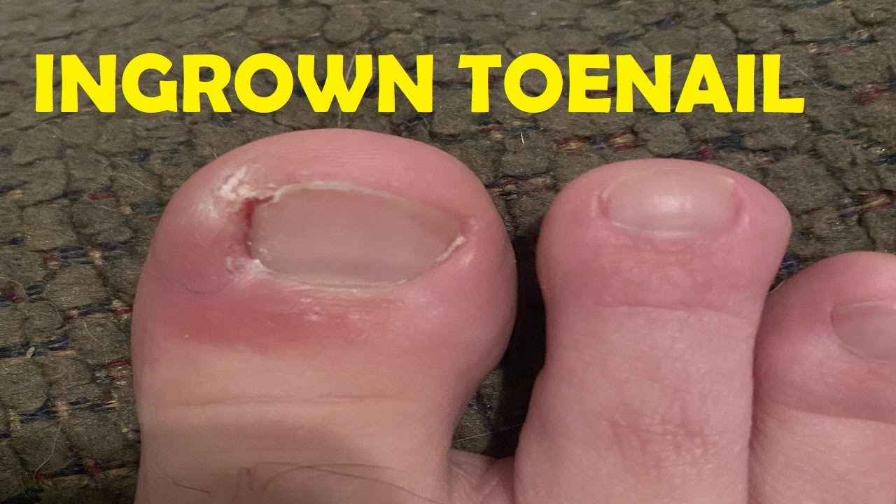 how to get rid of ingrown toenail on big toe easy way - YouTube