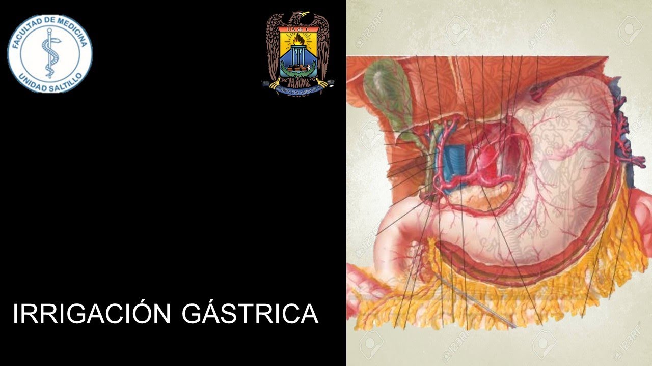 IRRIGACIÓN DE ESTÓMAGO - YouTube