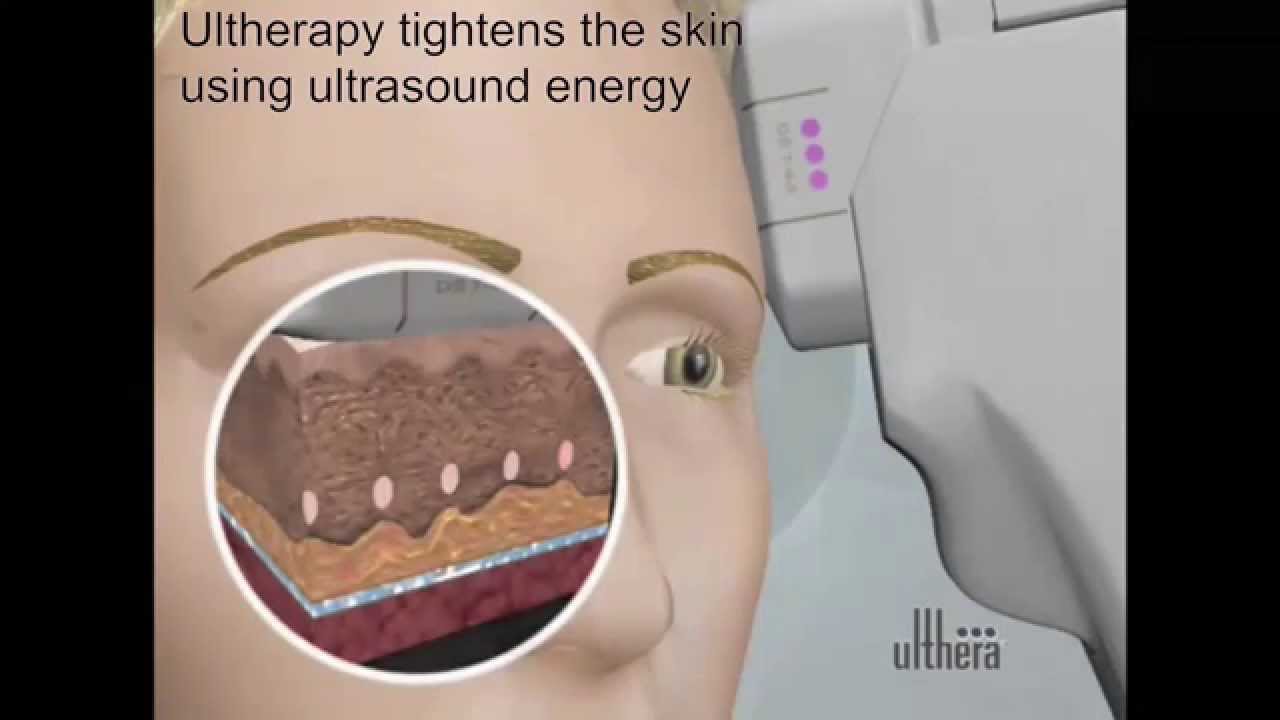 Ask A Dermatologist: How Does Ultherapy Skin Tightening Work? - YouTube