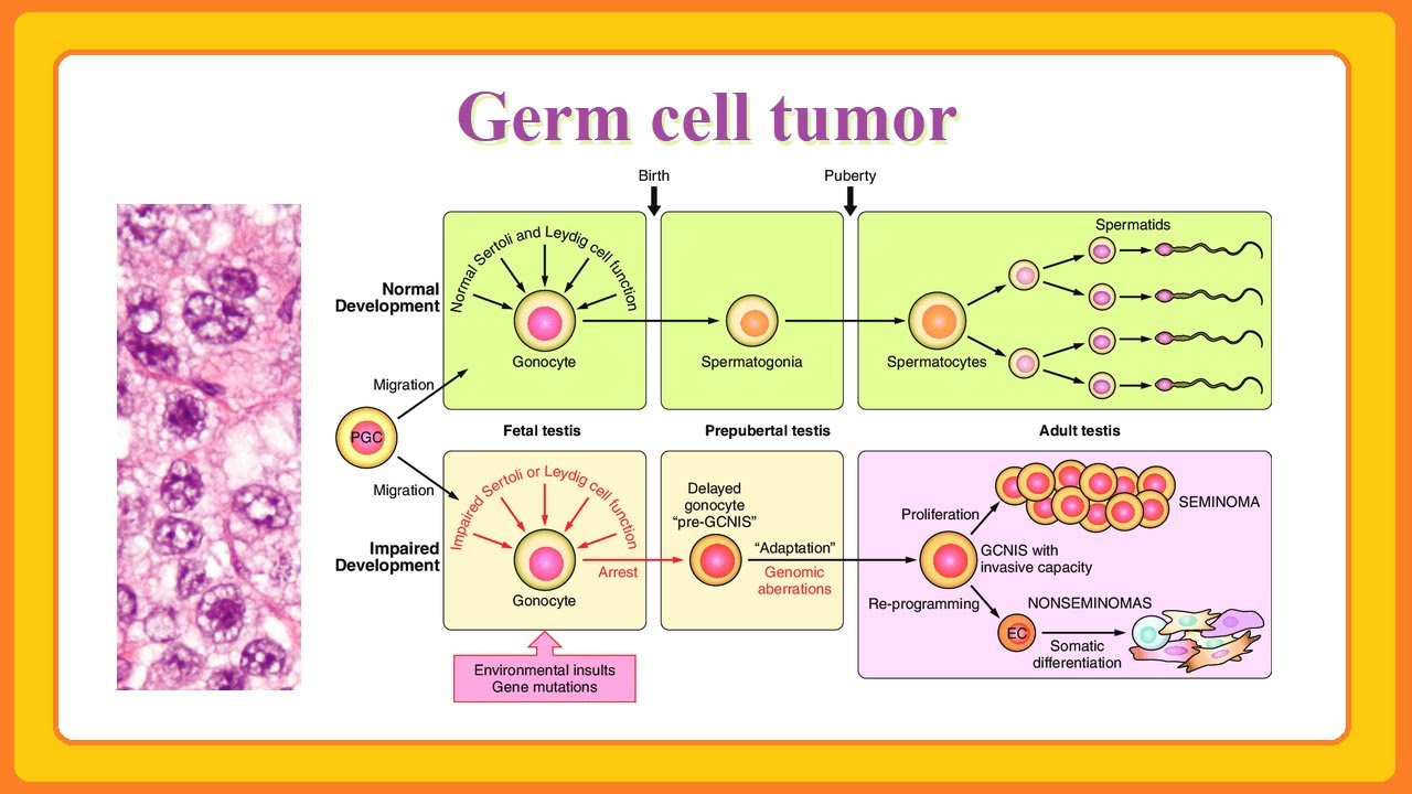 Germ Cell Tumor Youtube