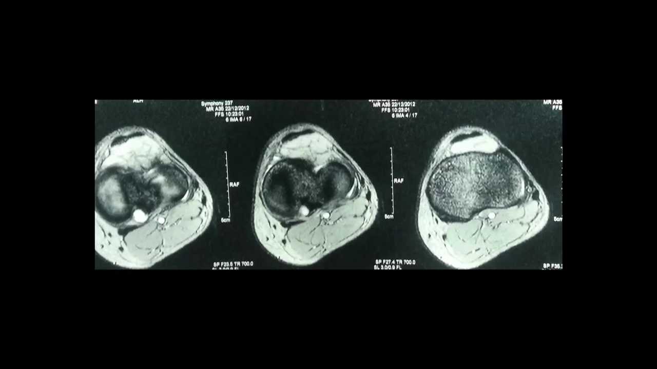 Arthroscopic treatment of PCL Cyst - YouTube