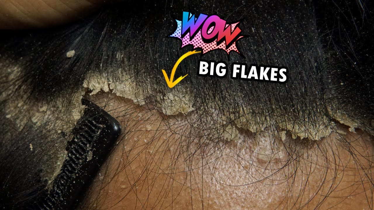 Super Big Dandruff Flakes Scratching Satisfying 391 Youtube