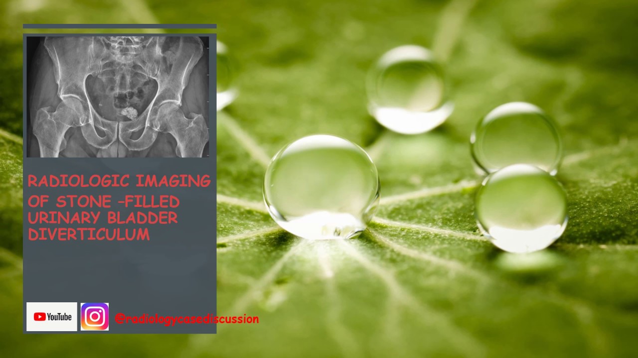 41 .Radiologic Imaging of Stone-Filled Urinary Bladder Diverticulum - YouTube