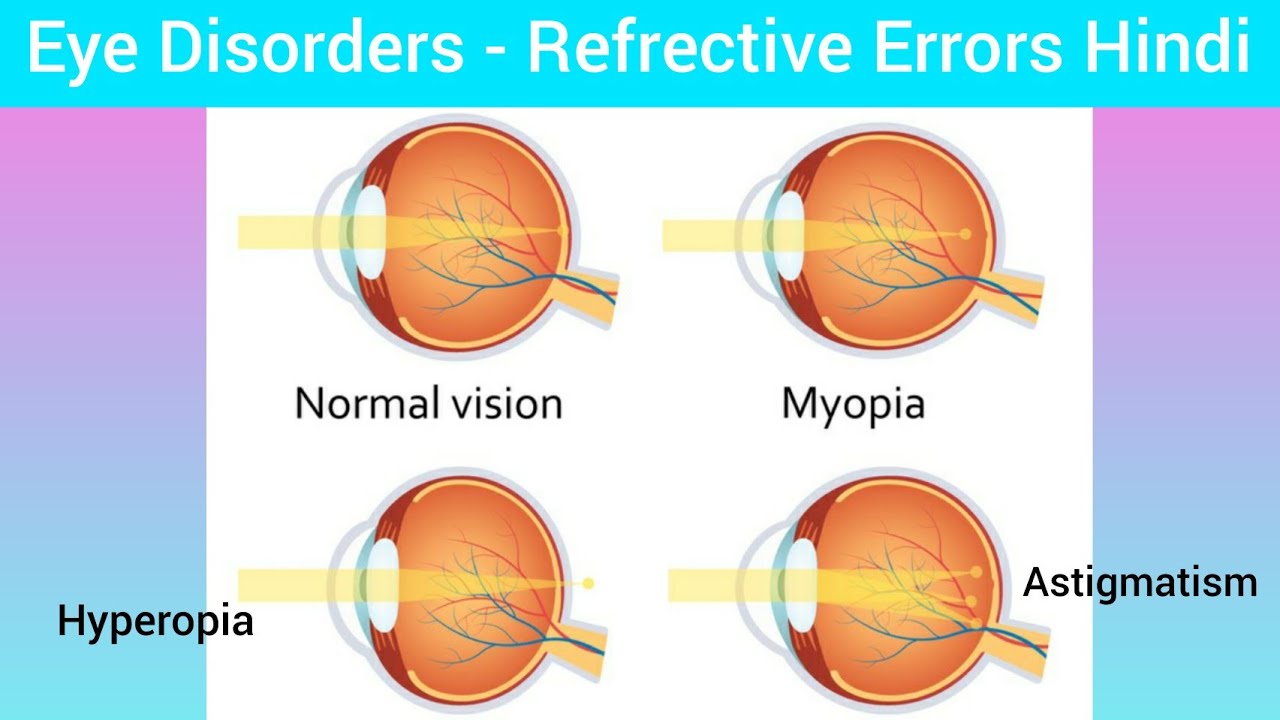 Refractive Errors of Eye in Hindi | Myopia, Hyperopia, Presbiopia ...