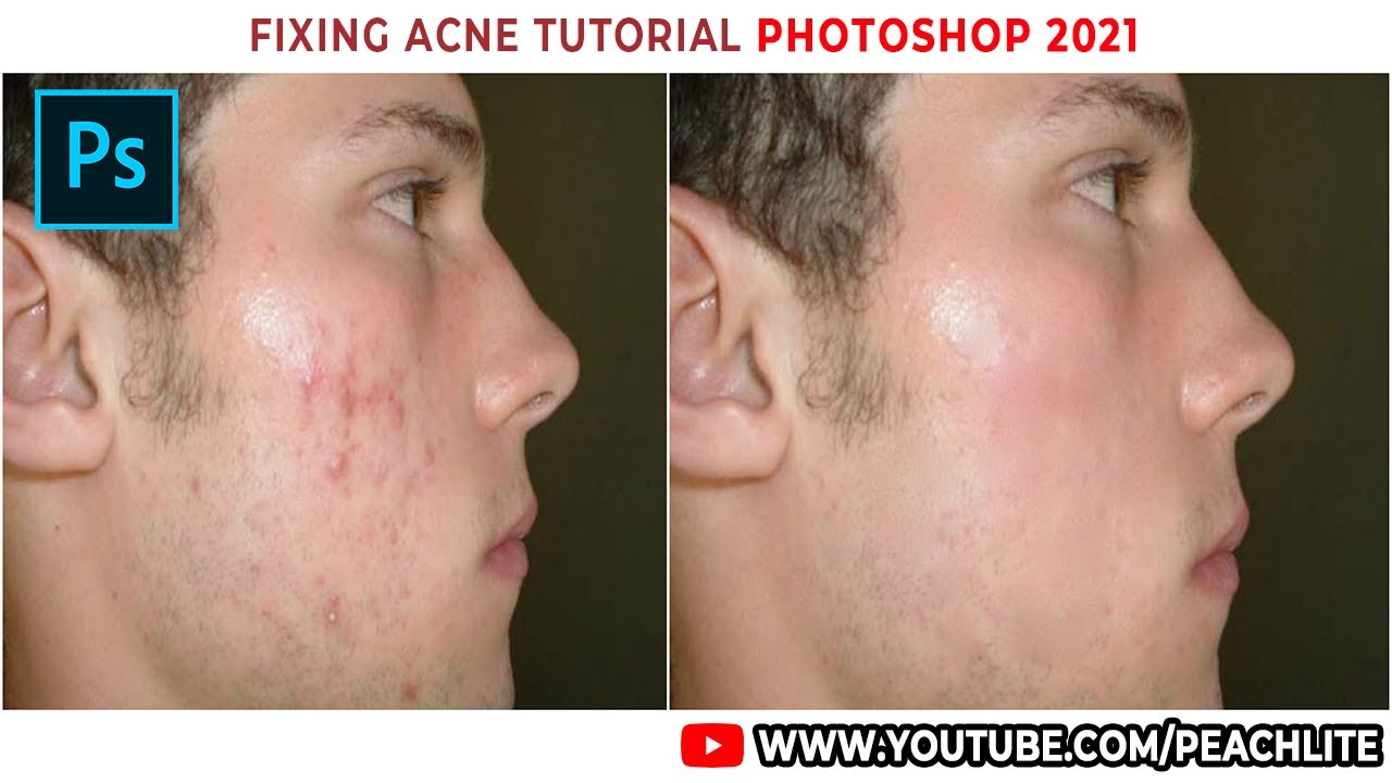 How To Remove Acne And Pimples In Photoshop | Tutorial #10 | Full ...