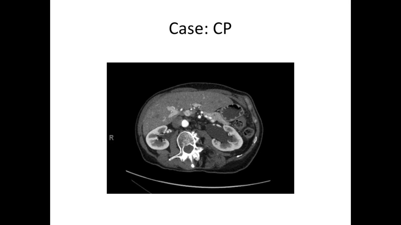 Malignant ureteric obstruction: focus on extrinsic compression - YouTube