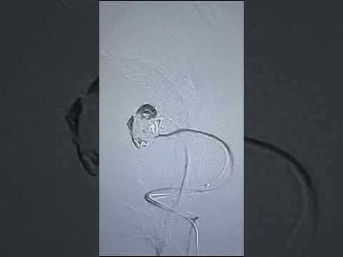 Managing Complex ACOM Aneurysm: Stent-Coiling, Thrombosis, and Spasm ...