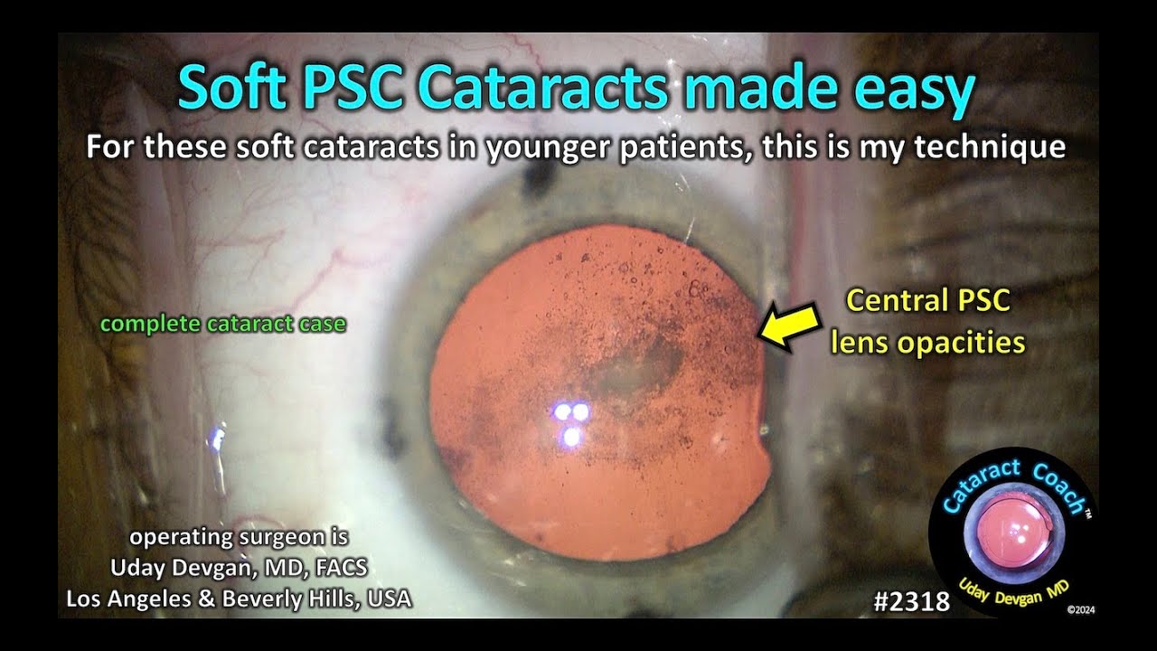 CataractCoach™ 2318: soft PSC cataracts made easy - YouTube