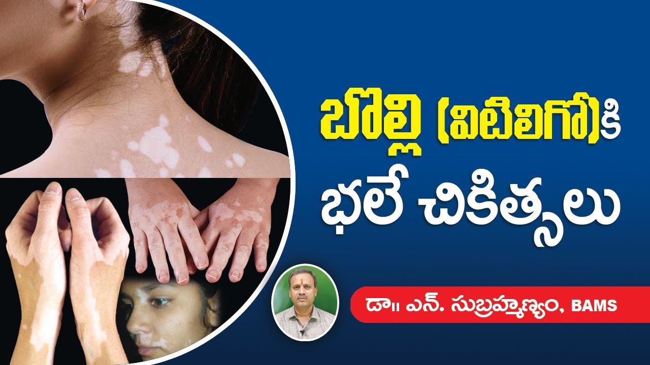 Leucoderma Causes & Treatment || Vitiligo || బొల్లి వ్యాధిని ...