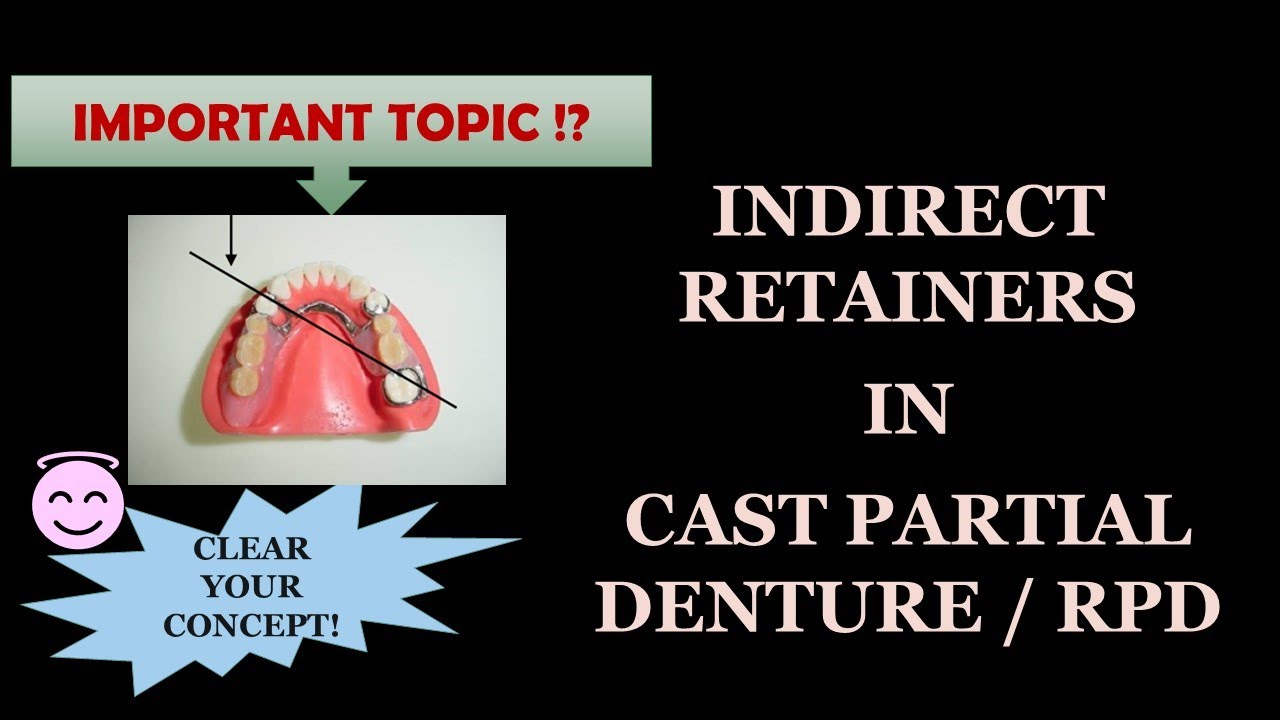 INDIRECT RETAINER IN CAST PARTIAL DENTURE / RPD - YouTube
