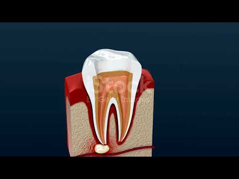 Cavity cleaning and preparation and tooth restoration - YouTube