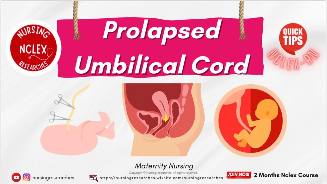 Prolapsed Umbilical Cord, Maternity Nursing Nclex Quick tips - YouTube